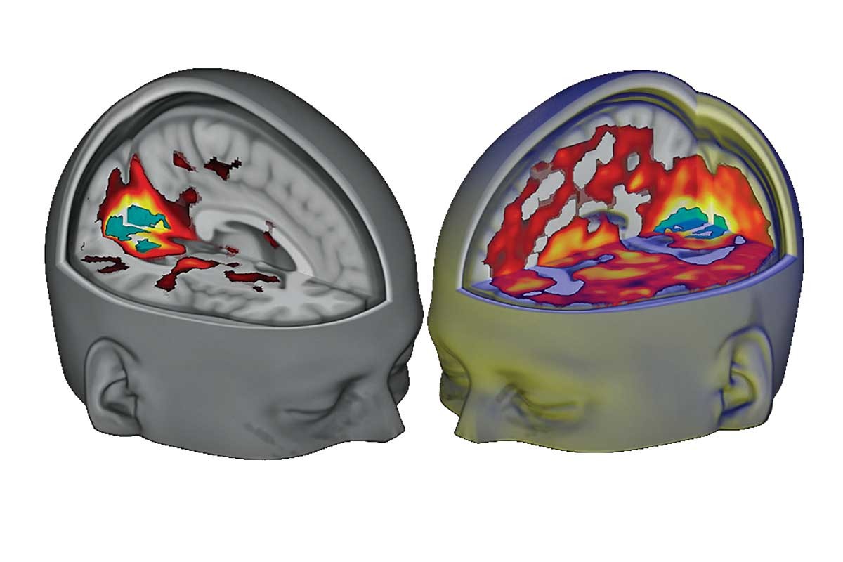 Así se reconecta el cerebro durante un ‘viaje’ de LSD / Noticias / SINC