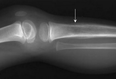 Descubierto uno de los mecanismos que favorece la agresividad del ...