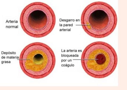 Nuevo mecanismo para revertir la aterosclerosis / Noticias / SINC